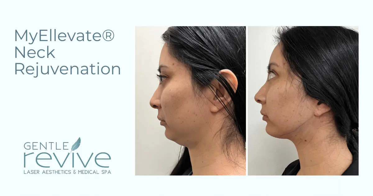 MyEllevate® | Neck Rejuvenation in Utah County